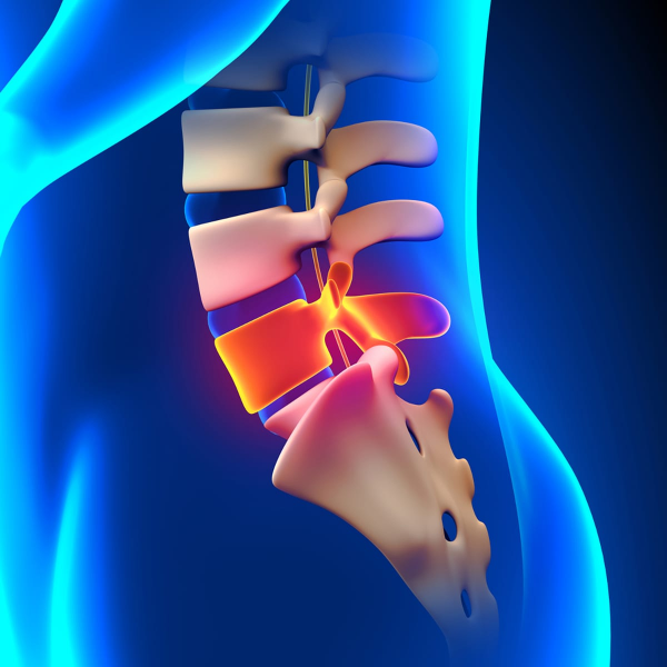 Microdiscectomy Surgery in Hyderabad