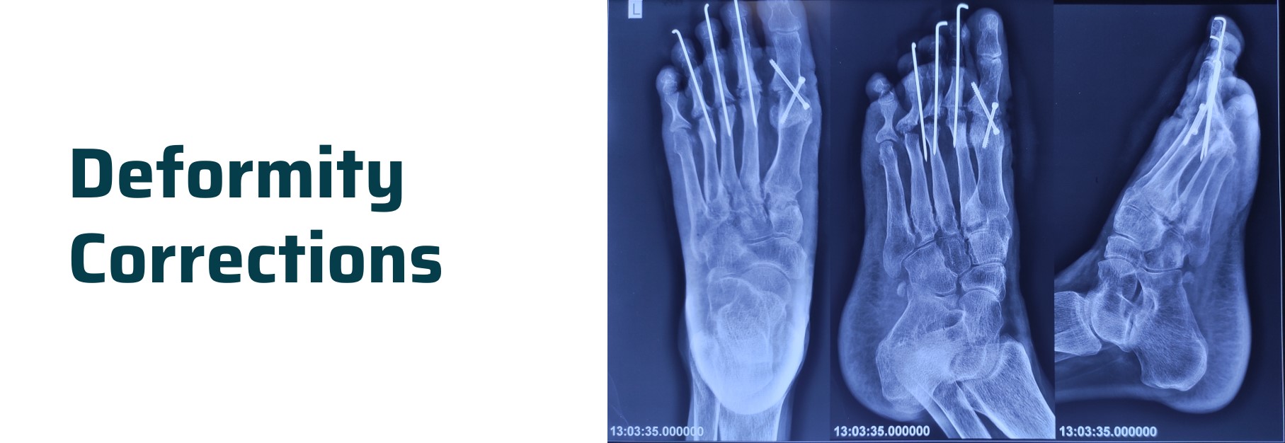 Deformity Correction Surgery